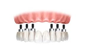 Een perfect vals gebit, Vink tandtechniek zorgt ervoor!